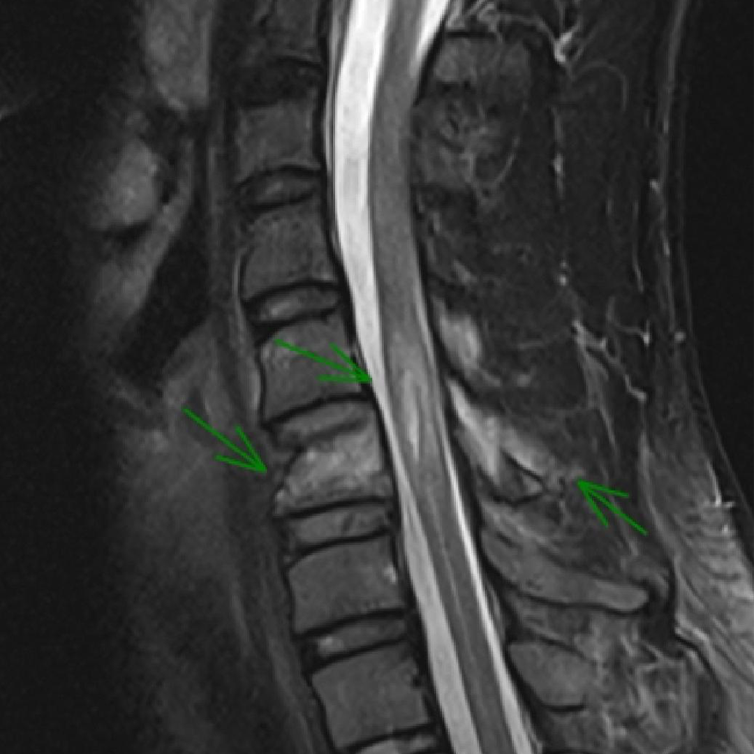 Mielopatia Cervical: Causa, Sintomas e Tratamento Cirúrgico – Dr ...